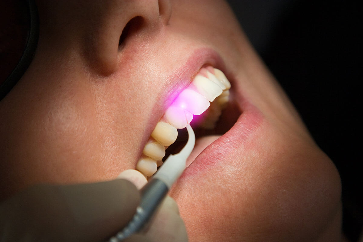 Benefits Of Laser Dental Procedures Dental Procedures Md